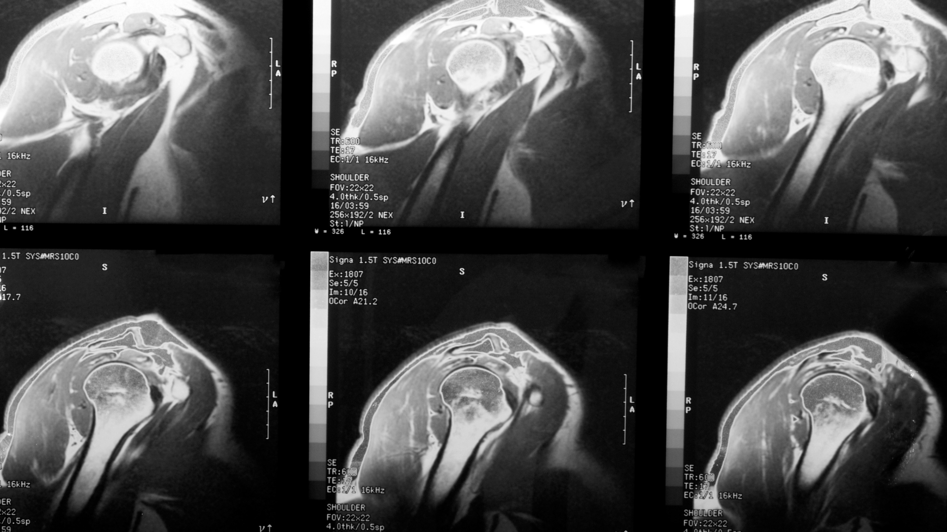 10 Types of Shoulder Surgeries: A Comprehensive Guide - Dr Amite Pankaj ...