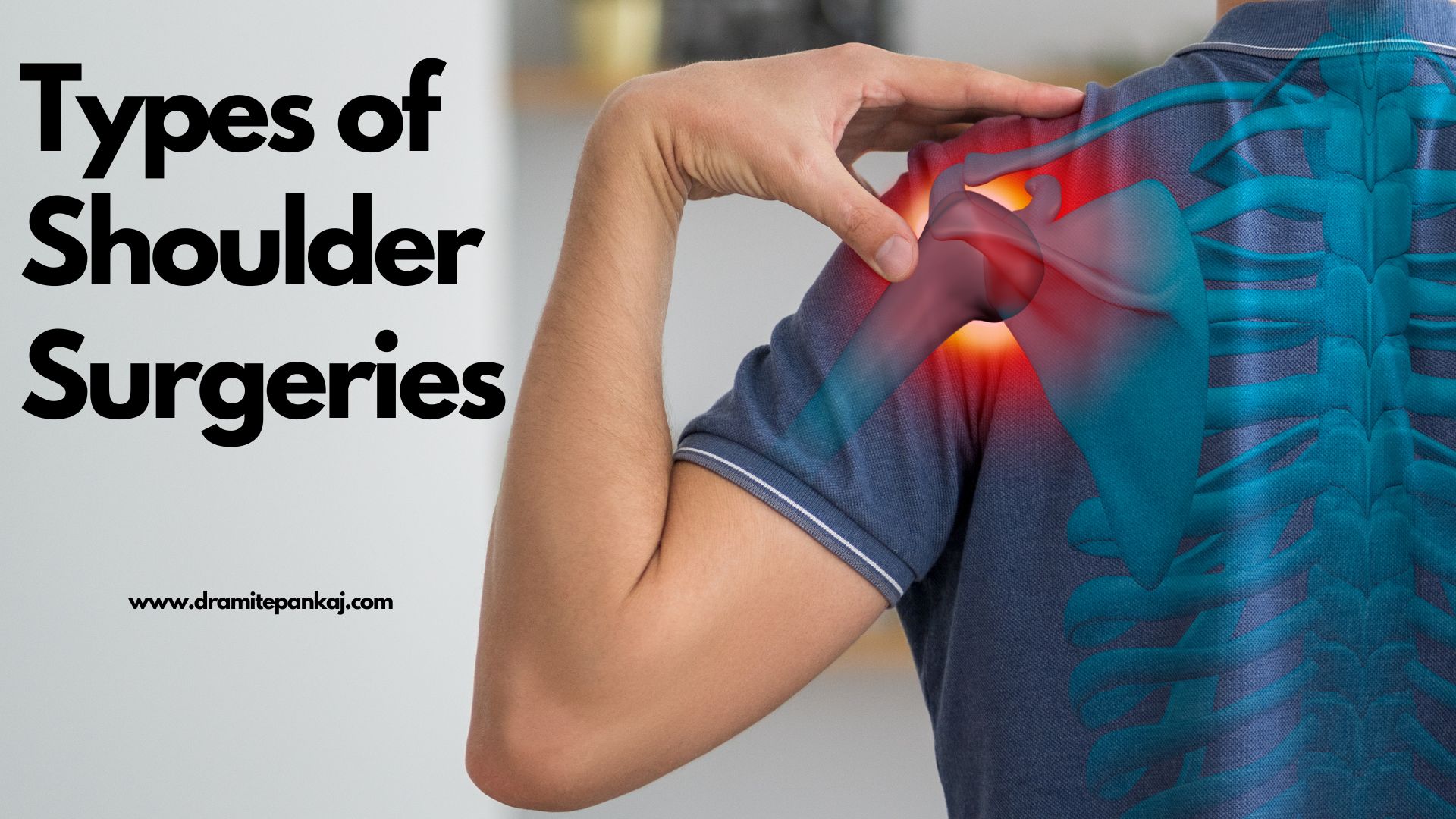 10 Types of Shoulder Surgeries: A Comprehensive Guide - Dr Amite Pankaj ...